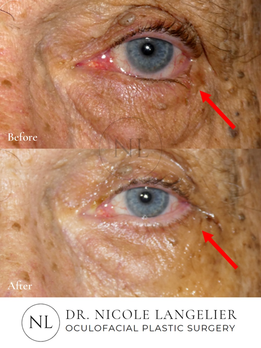 Entropion Repair | Dr. Langelier