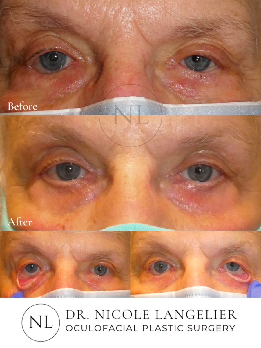 Entropion Repair | Dr. Langelier