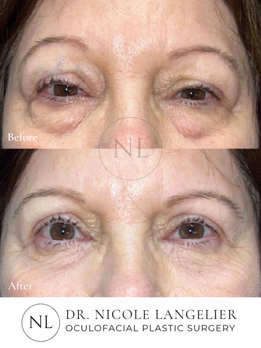 Female Lower Eyelid Blepharoplasty | Dr. Nicole Langelier