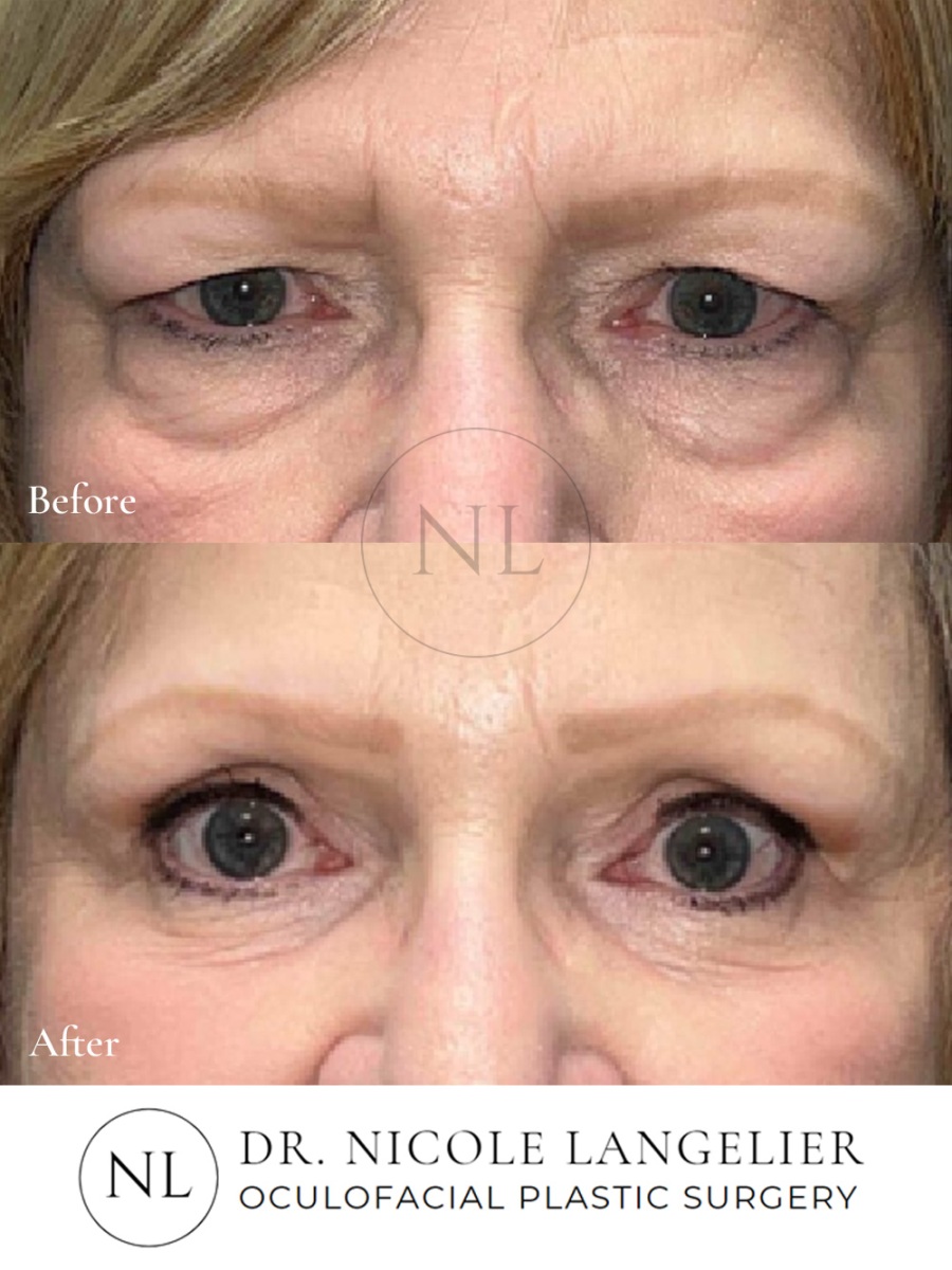 Female Lower Eyelid Blepharoplasty | Dr. Nicole Langelier