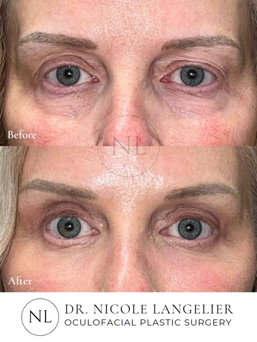 Female Lower Eyelid Blepharoplasty | Dr. Nicole Langelier