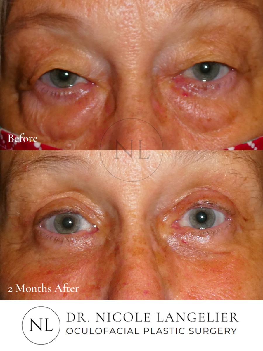 Female Lower Eyelid Blepharoplasty | Dr. Nicole Langelier