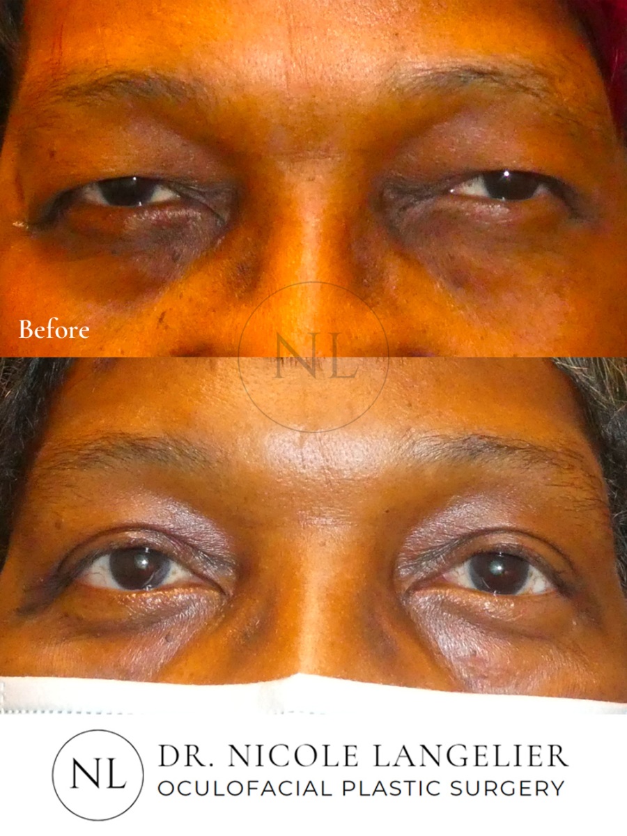 Female Upper Eyelid Blepharoplasty | Dr. Nicole Langelier