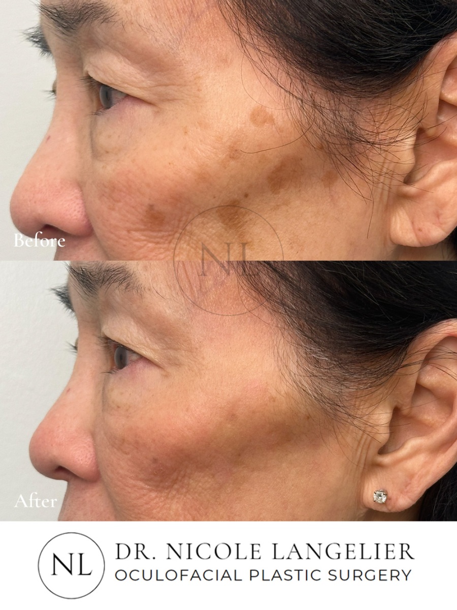 HALO + BBL | Dr. Nicole Langelier