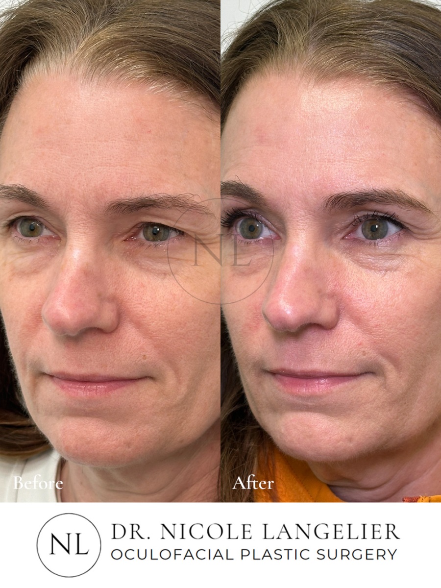 HALO + BBL | Dr. Nicole Langelier