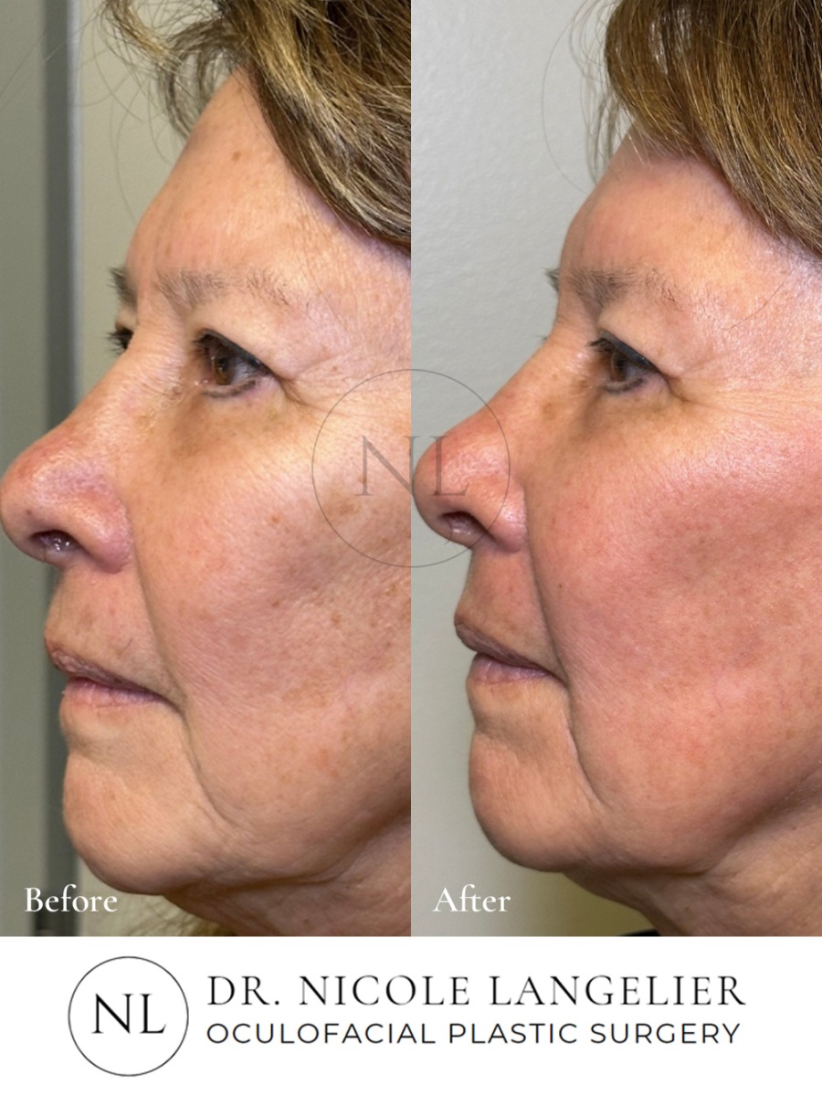 HALO + BBL | Dr. Nicole Langelier