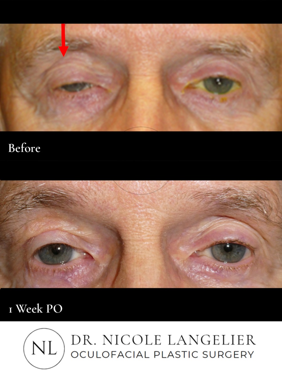 Ptosis Repair | Dr. Nicole Langelier